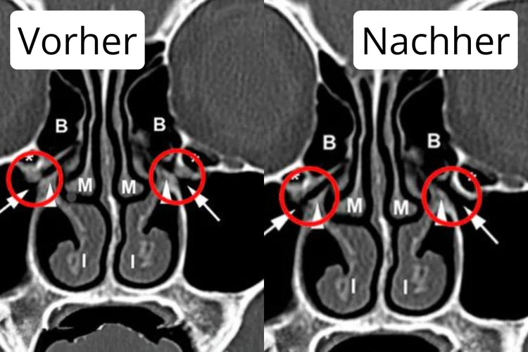 Nasamed | Infrarot-Sinusitistherapie für freie Atemwege – Hermhoffer